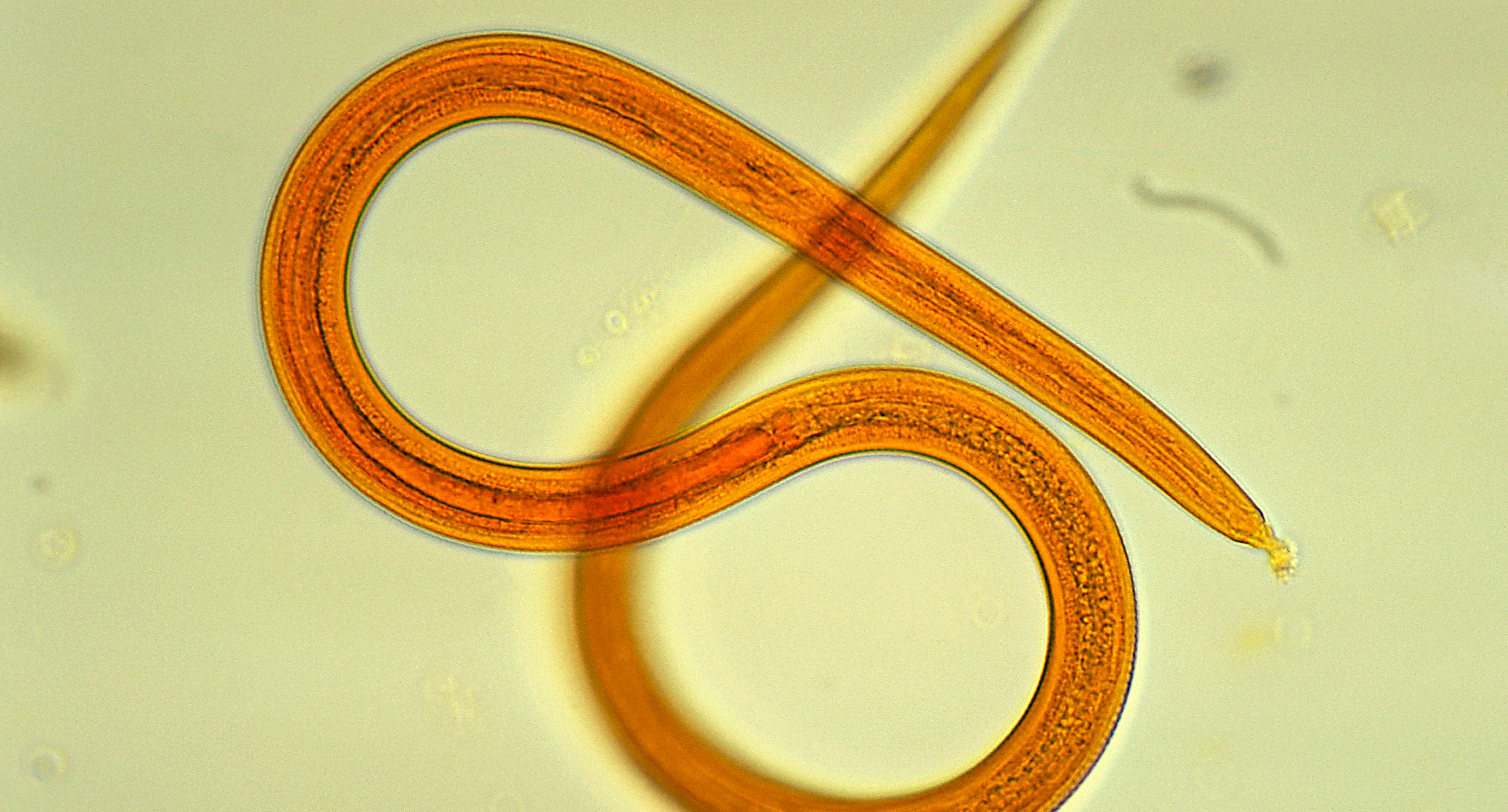 Woman Finds A Live 1.5-Inch Long Worm Living In Her Tonsils After ...