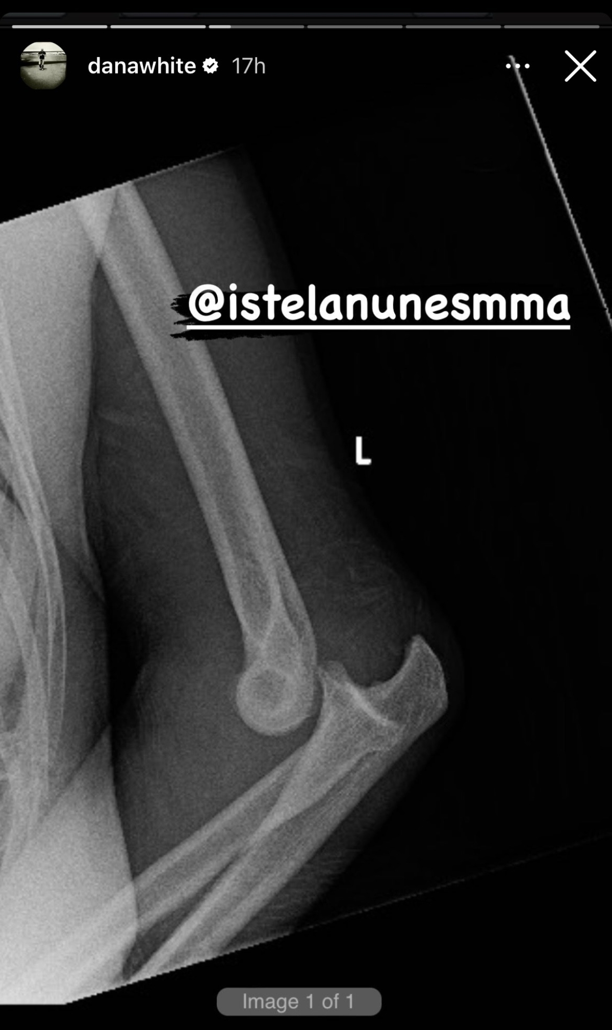 UFC Fighter Istela Nunes Reveals X-Ray Results Of Nasty Elbow Injury
