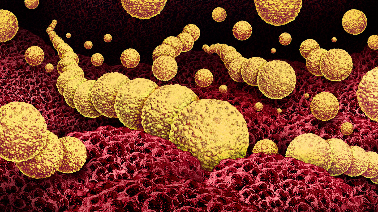 Flesh-Eating Bacteria Cases Are On The Rise In America